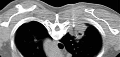 Percutaneous Marker Placement Under Ct Guidance A Prior To Treatment Download Scientific