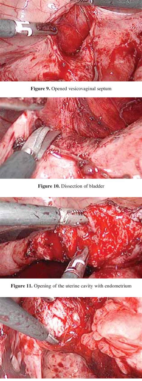 Laparoscopic Vaginal Dissection Of The Apex Of Vagina Download Scientific Diagram