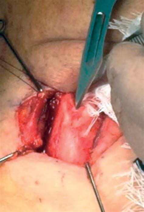 Isshiki Thyroplasty Type 2 Ent And Audiology News