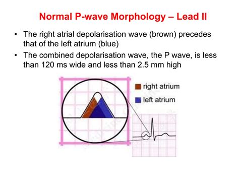P Wave In Ecgabnormalities Of P Wave In Ecg Pptx