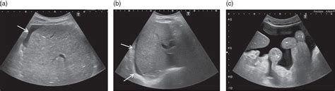 Ultrasound In Chronic Liver Disease Radiology Key
