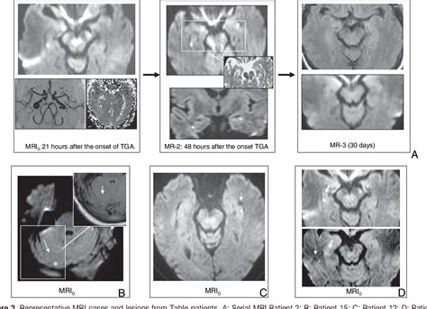 Figure 2 From Lack Of Evidence For Arterial Ischemia In Transient Global Amnesia Semantic Scholar