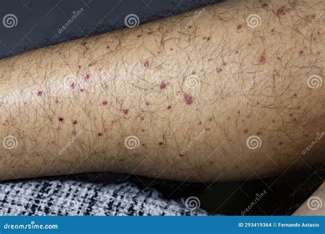 Vasculitis Vasculitis In Legs Small Red Or Purple Spots Rare Disease