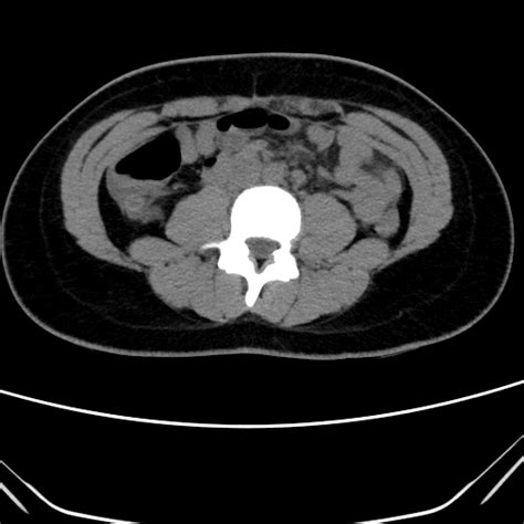 Radiopaedia Case Perforated Subhepatic Appendicitis Id 83963 Study