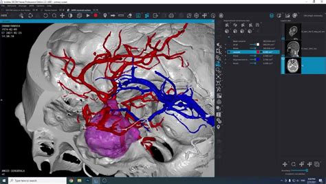 3d Reconstruction Of Giant Brain Tumor ⠀ Complex 3d Segmentation Using