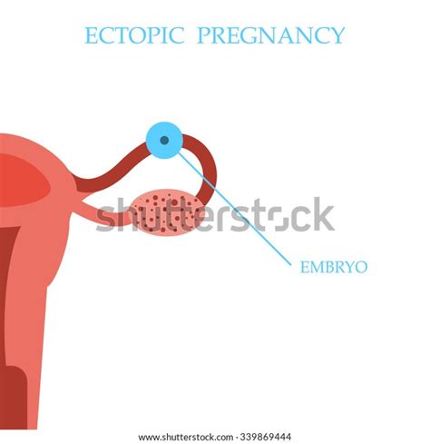 Ectopic Pregnancy Concept Vector Illustration Stock Vector Royalty
