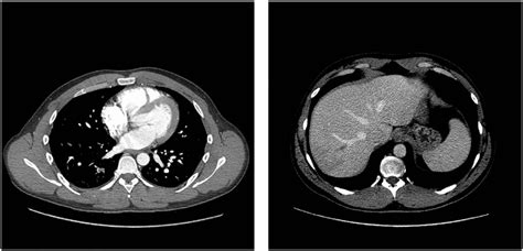 Shows Multiple Segmental And Subsegmental Pulmonary Emboli Throughout Download Scientific