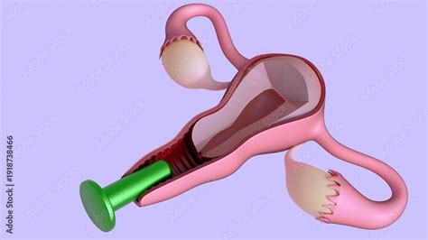 Stock Illustration „a 3d Rendering Of One Dilator Is Inserted Into The
