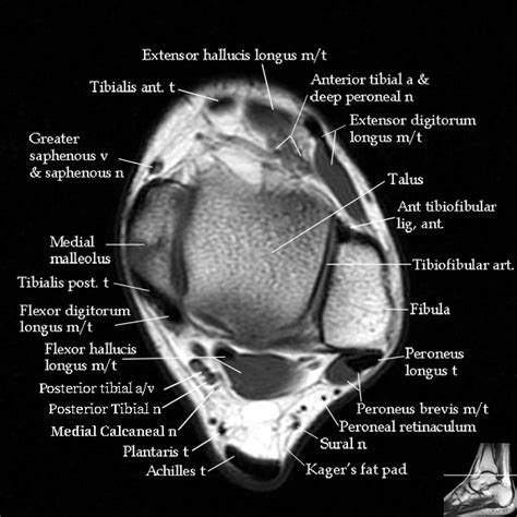 Labeled Ankle Mri At Amy Kates Blog