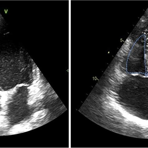 Global Right Ventricular Longitudinal Strain Rvls To Perform The Download Scientific Diagram
