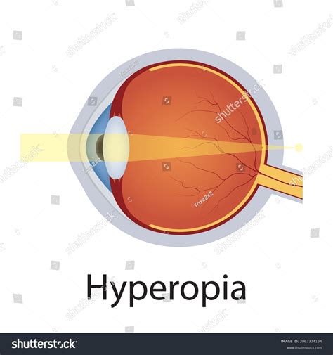 Hyperopia And Vision Disorders Illustration Royalty Free Stock