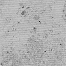 The Lesion Of The Skin Form Lymphoma Is Characterized By CD3 Positive Download Scientific