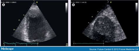 Management Of Lv Thrombus