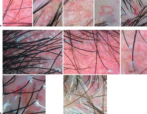Clinical And Dermoscopic Features Of The Scalp In 31 Patients With Dermatomyositis Pmc