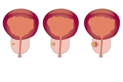 Import Ncia Da Bi Psia Para Determinar O Tipo De Agressividade Do C Ncer De Pr Stata Folha