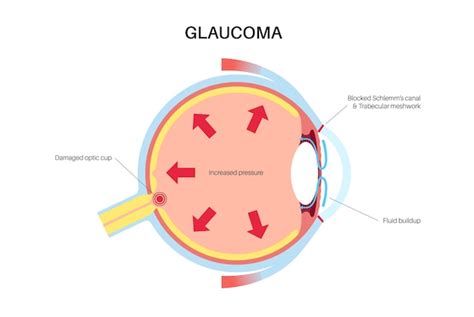 Presión Ocular Del Glaucoma Vector Premium
