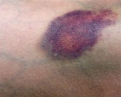 Bloeduitstorting Info Vandaag