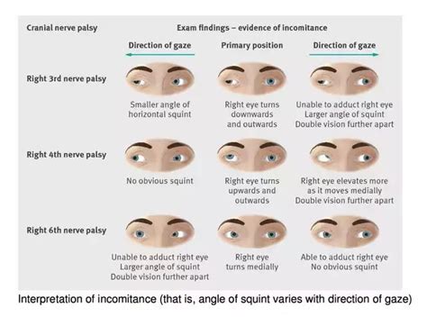 Cranial Nerve 3 Palsy