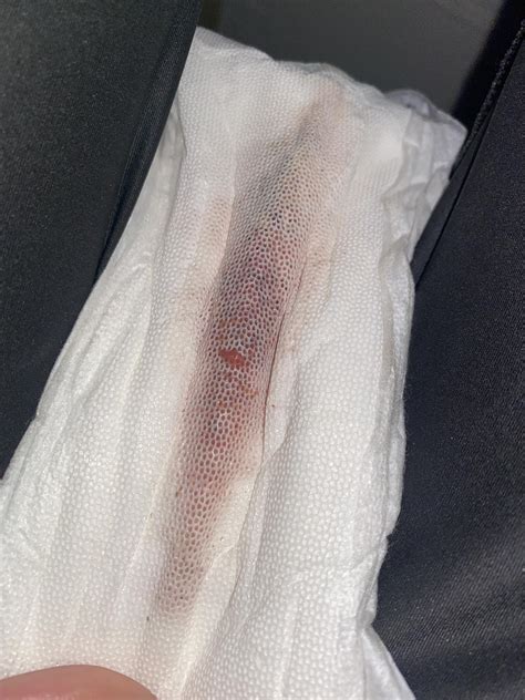 Implantation Bleeding Rpregnancycare