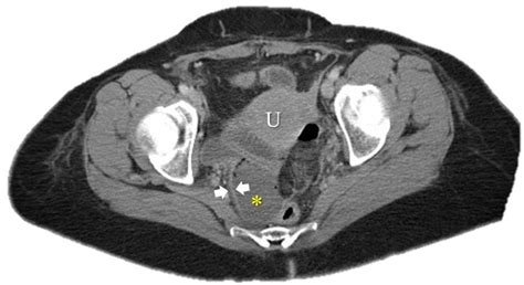 Axial Image Of Pelvic Collection U Uterus Pelvic Abscess Cavity