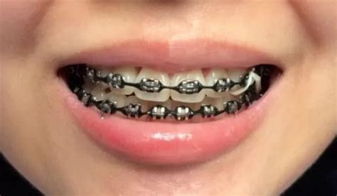 Elegance Redefined Discover Black Braces Color Options