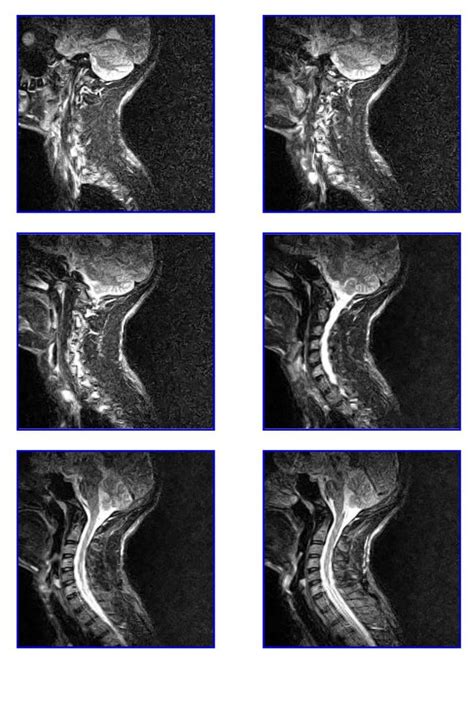 Nerve Or Spine Compression R Spinesurgery
