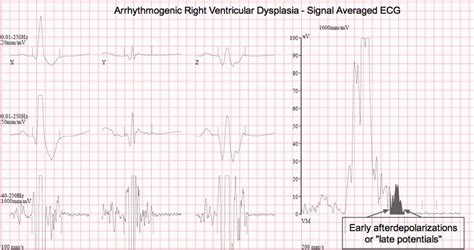 Arrhythmogenic Right Ventricular Dysplasia Arvd Topic Review