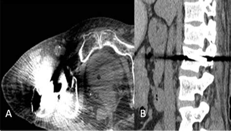 Beam Hardening Artifact Ct Radiology The Best Picture Of Beam