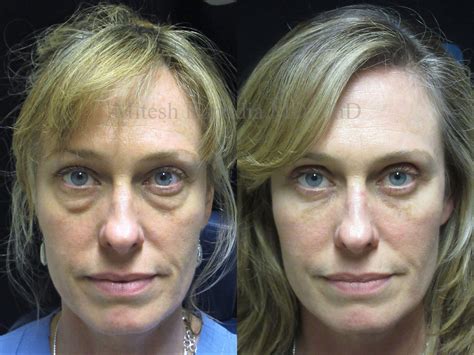 Before And Three Months After Upper And Lower Blepharoplasty Surgery