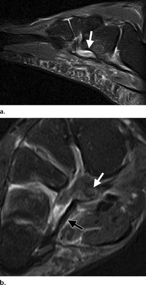 Full Thickness Peroneus Longus Tendon Tear In A 66 Year Old Man A