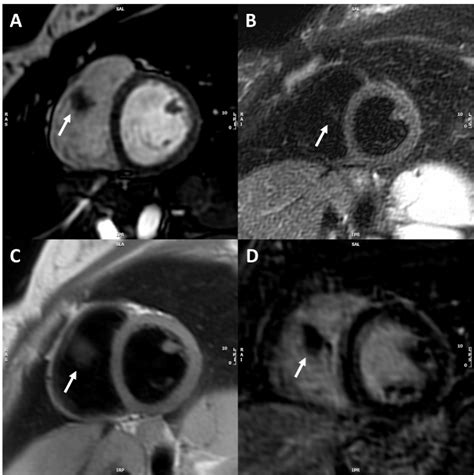 Figure 2 From A Rare Case Of Tricuspid Valve Libman Sacks Endocarditis In A Pregnant Woman With