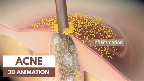 Acne Types Causes Treatment And Prevention