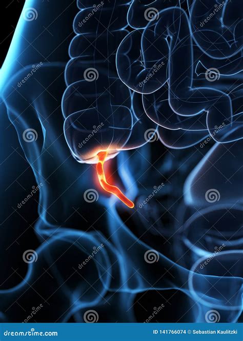 An Inflamed Appendix Stock Illustration Illustration Of Anatomy 141766074
