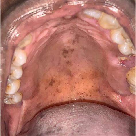 Hyperpigmented Spots On The Hard Palate Download Scientific Diagram Hyperpigmented Spots On The Hard Palate Download Scientific Diagram