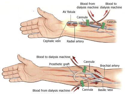 Dialysis Fistula Diagram