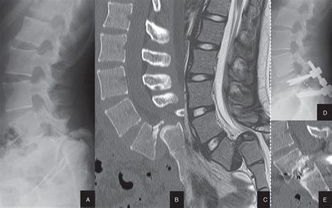 Instrumented Reduction And Monosegmental Fusion For Meyerding Grade Iv Developmental