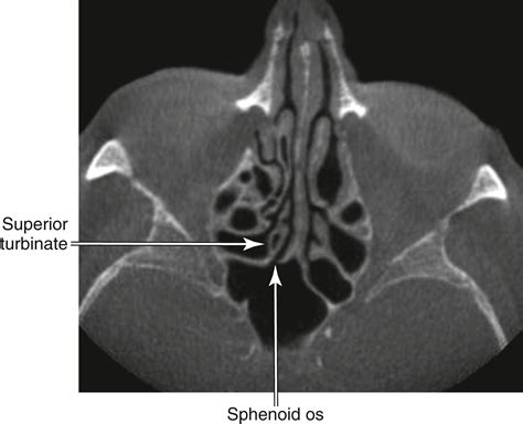Atlas Of Endoscopic Sinus And Skull Base Surgery