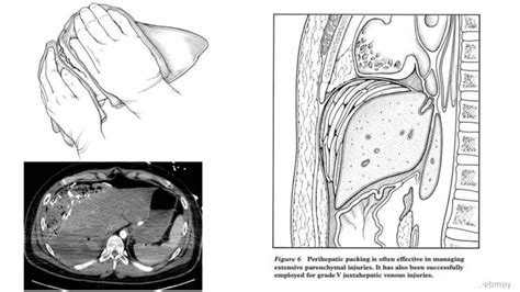 Retrohepatic Ivc Injuries Evaluation And Assessmentpptx