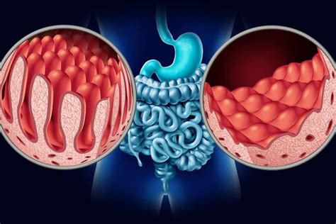 Understanding Celiac Disease Pathology Outlines