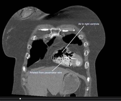 Ct Case 098 • Litfl • Ct Scan Interpretation