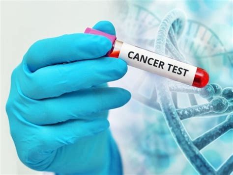 Хавдраар өвдсөн иргэдийн 65 хувь нь хожуу шатандаа оношлогдож байна