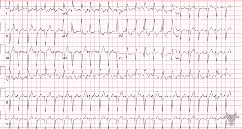 Bifascicular Block Ecg Stampede