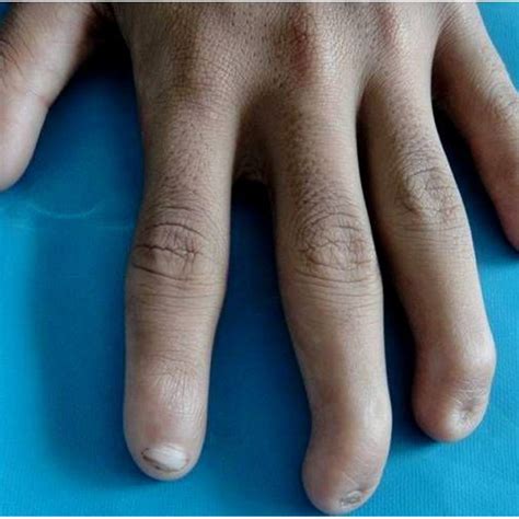 Complete Absence Of Nails Of Little And Ring Finger Of The Right Hand