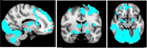 Whole Brain Activation In Response To Anger Vs Baseline Fixation