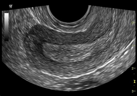 Uterine Fibroid Object Detection Dataset By Capstoneproject