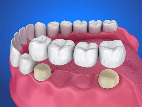 Fixed Partial Denture Bridge