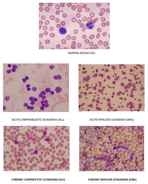 Leukemia Can Be Acute Fast Growing Or Chronic Slow Developing In