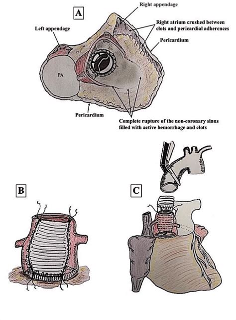 A Illustration Of The Aortic Root Showing A Complete Rupture Of The