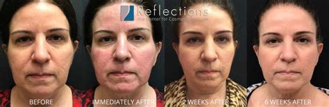 Glutathione Injection Before And After