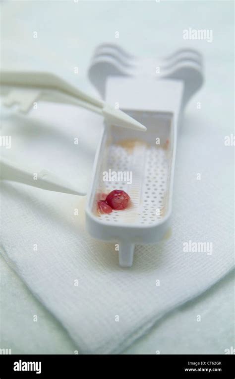 Polypen Im Dickdarm Anatomie Stockfotografie Alamy